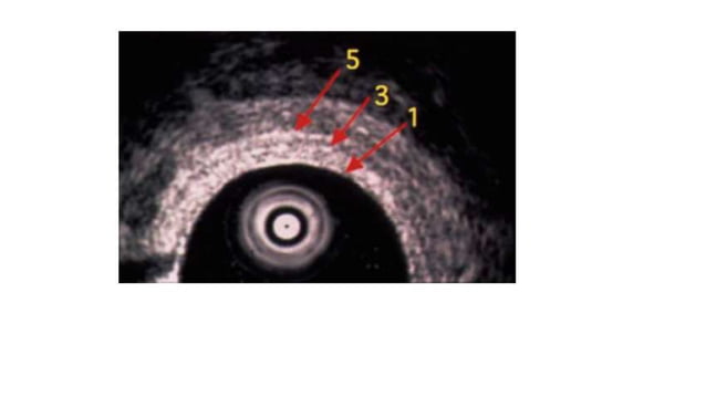 Endobronchial ultrasound - EBUS | PPTX | Lung and Respiratory Health ...