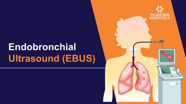 Endobronchial Ultrasound Bronchoscopy (EBUS) | PPTX | Lung and ...