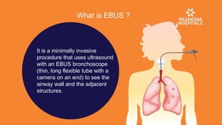 Endobronchial Ultrasound Bronchoscopy (EBUS) | PPTX