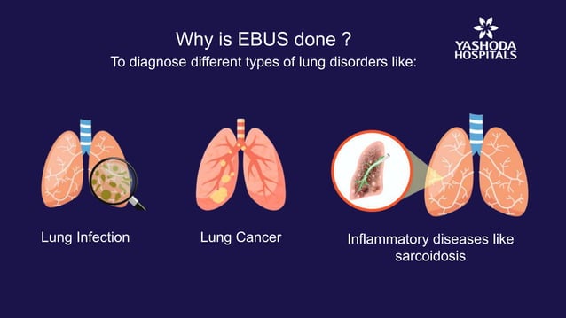 Endobronchial Ultrasound Bronchoscopy (EBUS) | PPTX | Lung and ...