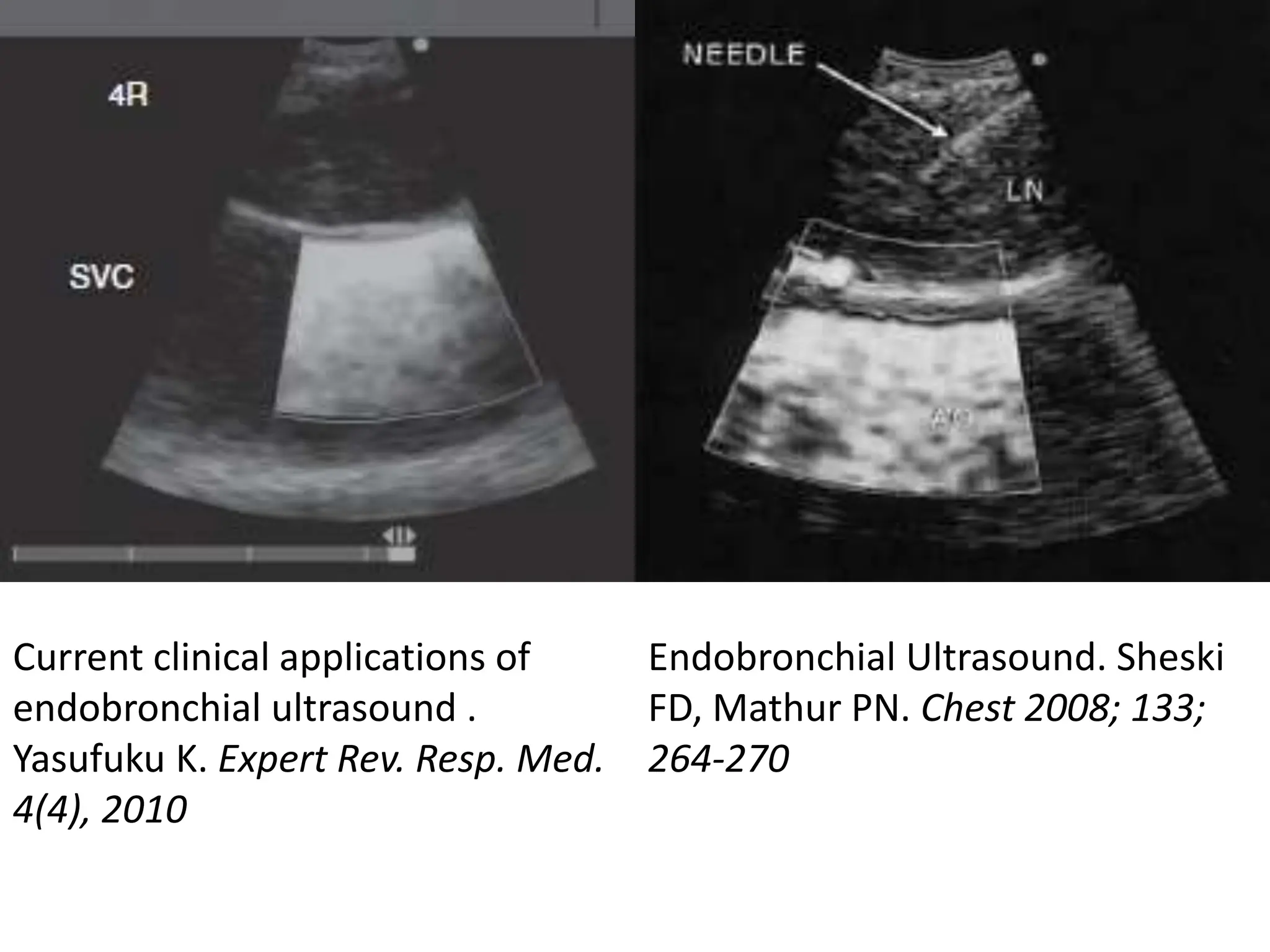 Endobronchial Ultrasound Ebus By Dr Adityapptx