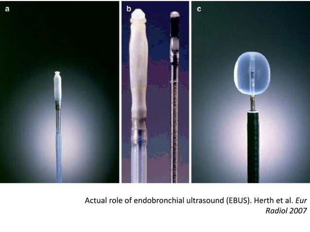 Endobronchial Ultrasound (EBUS) by Dr. Aditya.pptx