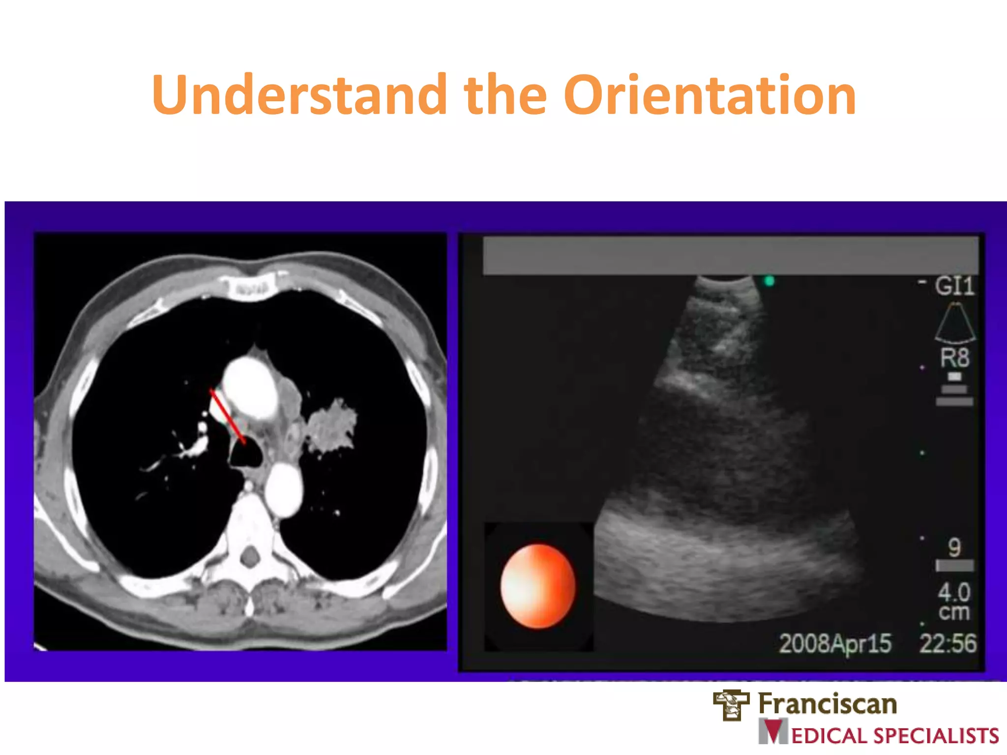 Endobronchial Ultrasound Guidance of TBNA. Current Approach To Lung ...