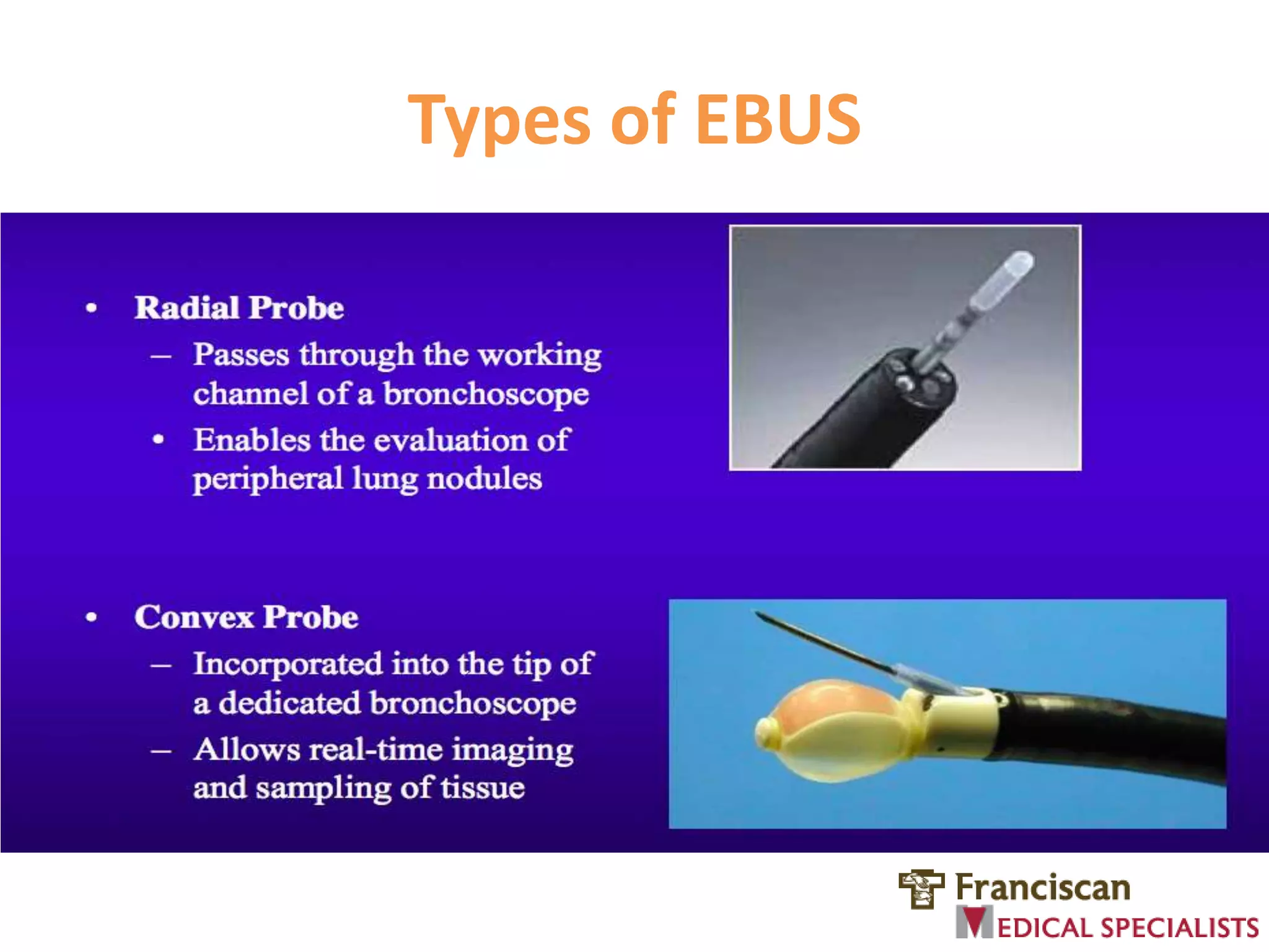 Endobronchial Ultrasound Guidance of TBNA. Current Approach To Lung Cancer Staging: How EBUS ...