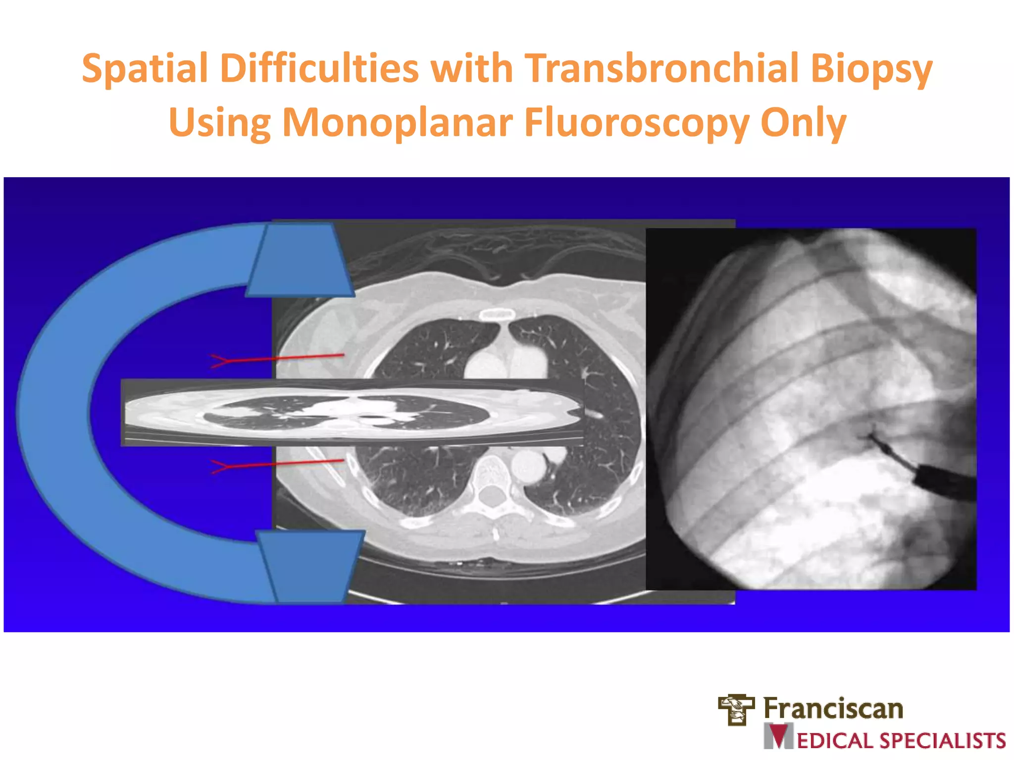 Endobronchial Ultrasound Guidance of TBNA. Current Approach To Lung ...