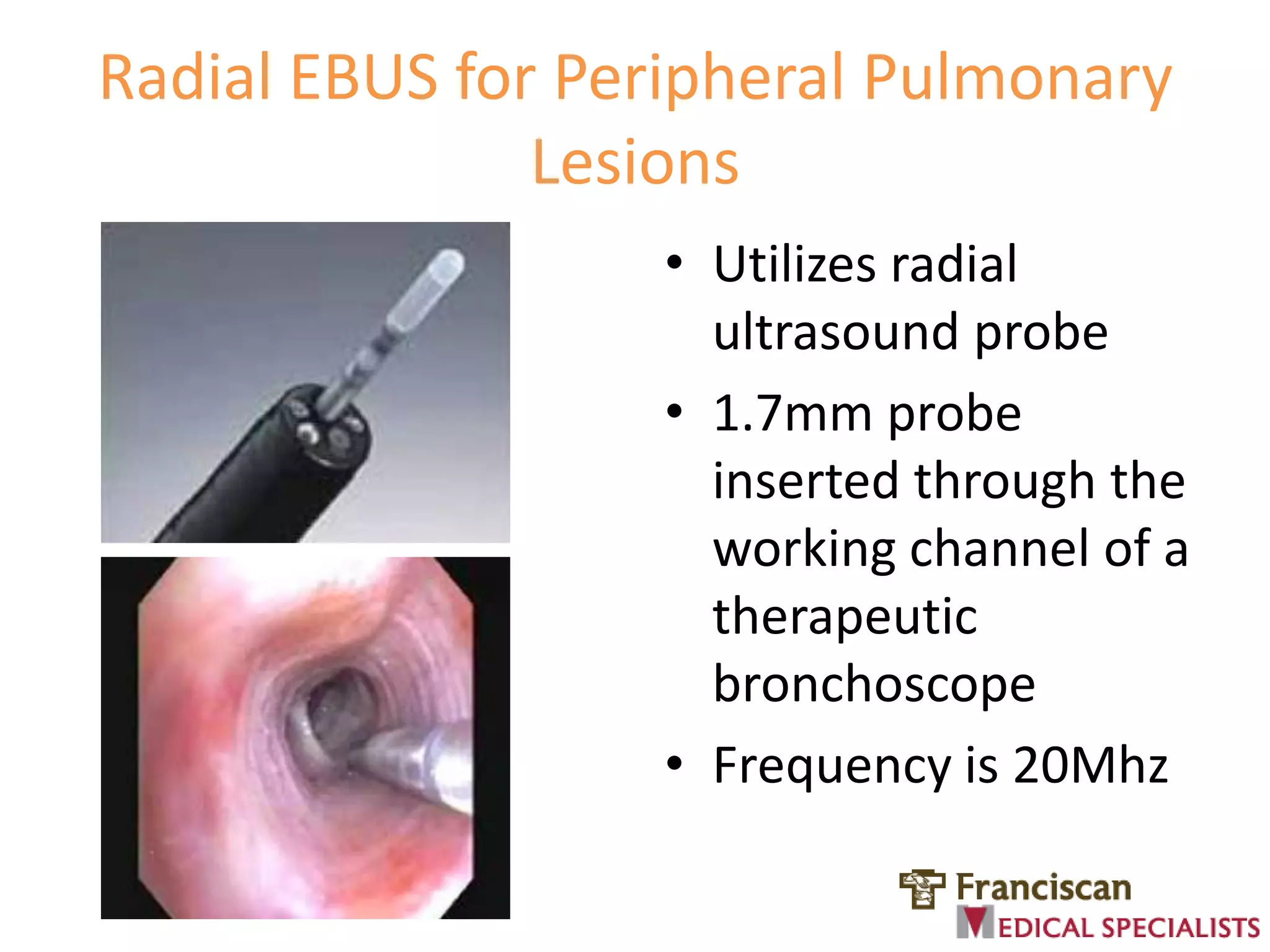 Endobronchial Ultrasound Guidance of TBNA. Current Approach To Lung Cancer Staging: How EBUS ...