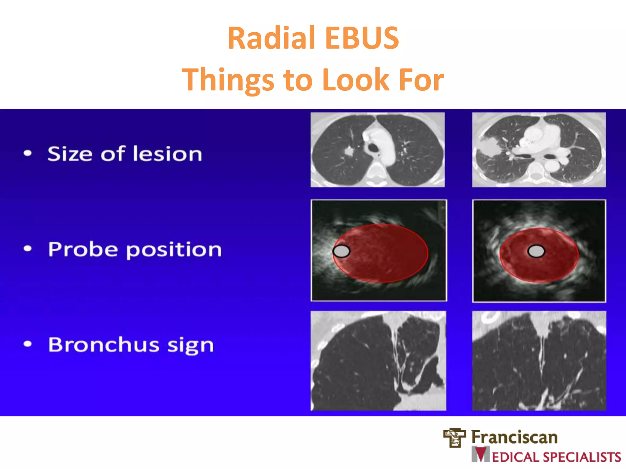 Endobronchial Ultrasound Guidance of TBNA. Current Approach To Lung ...
