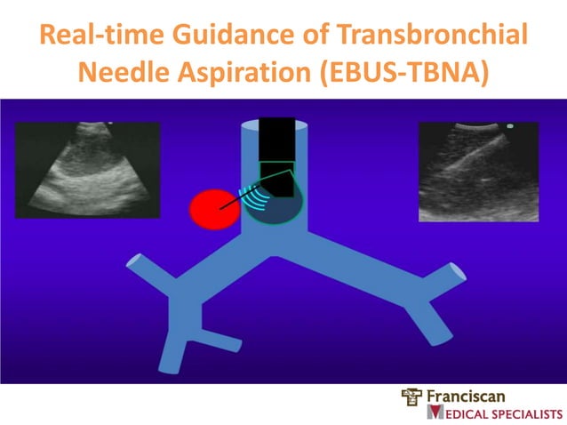 Endobronchial Ultrasound Guidance of TBNA. Current Approach To Lung Cancer Staging: How EBUS ...