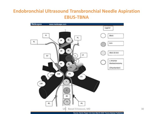 Endobronchial Ultrasound Guidance of TBNA. Current Approach To Lung Cancer Staging: How EBUS ...