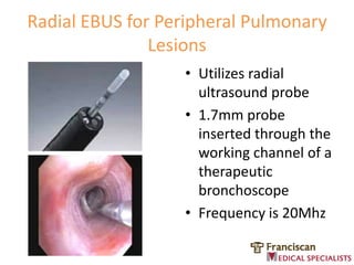 Endobronchial Ultrasound Guidance of TBNA. Current Approach To Lung Cancer Staging: How EBUS ...