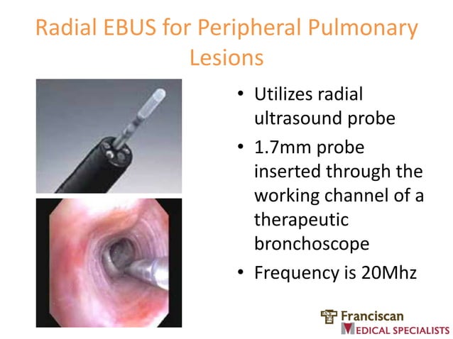 Endobronchial Ultrasound Guidance of TBNA. Current Approach To Lung ...