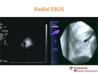 Endobronchial Ultrasound Guidance of TBNA. Current Approach To Lung ...