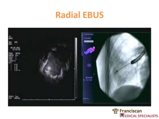 Endobronchial Ultrasound Guidance of TBNA. Current Approach To Lung ...