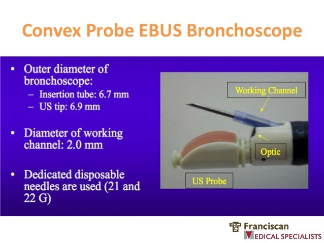 Endobronchial Ultrasound Guidance of TBNA. Current Approach To Lung C…
