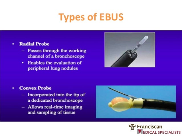 Endobronchial Ultrasound Guidance of TBNA. Current Approach To Lung C…