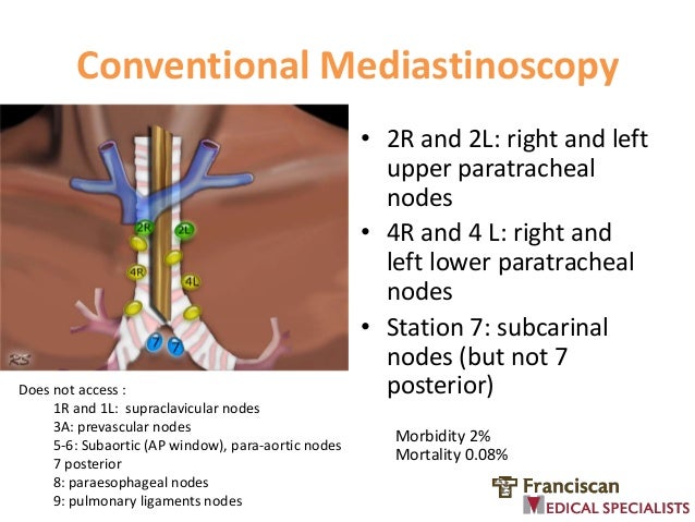 Endobronchial Ultrasound Guidance of TBNA. Current Approach To Lung C…