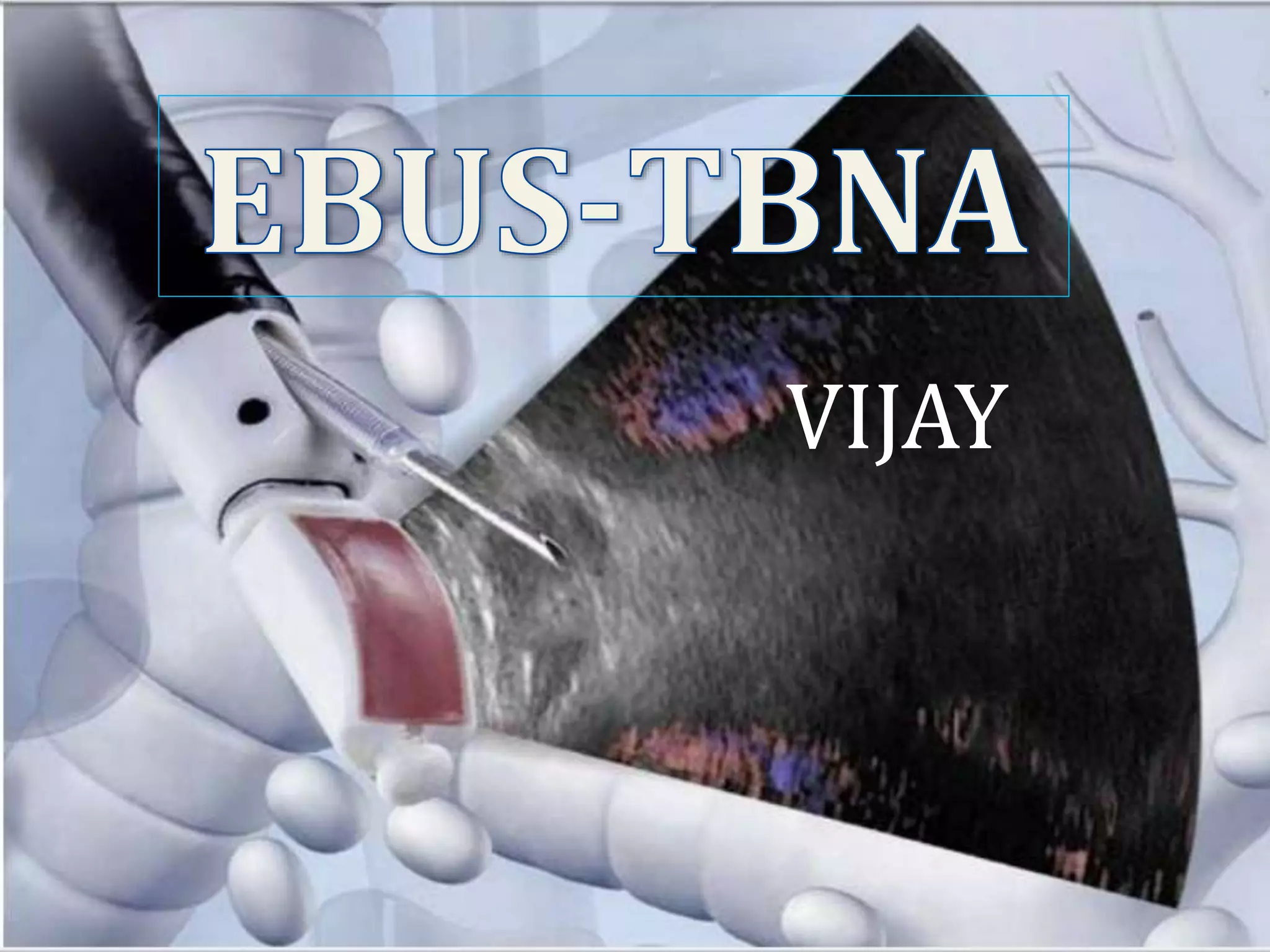 EBUS-TBNA | PPTX