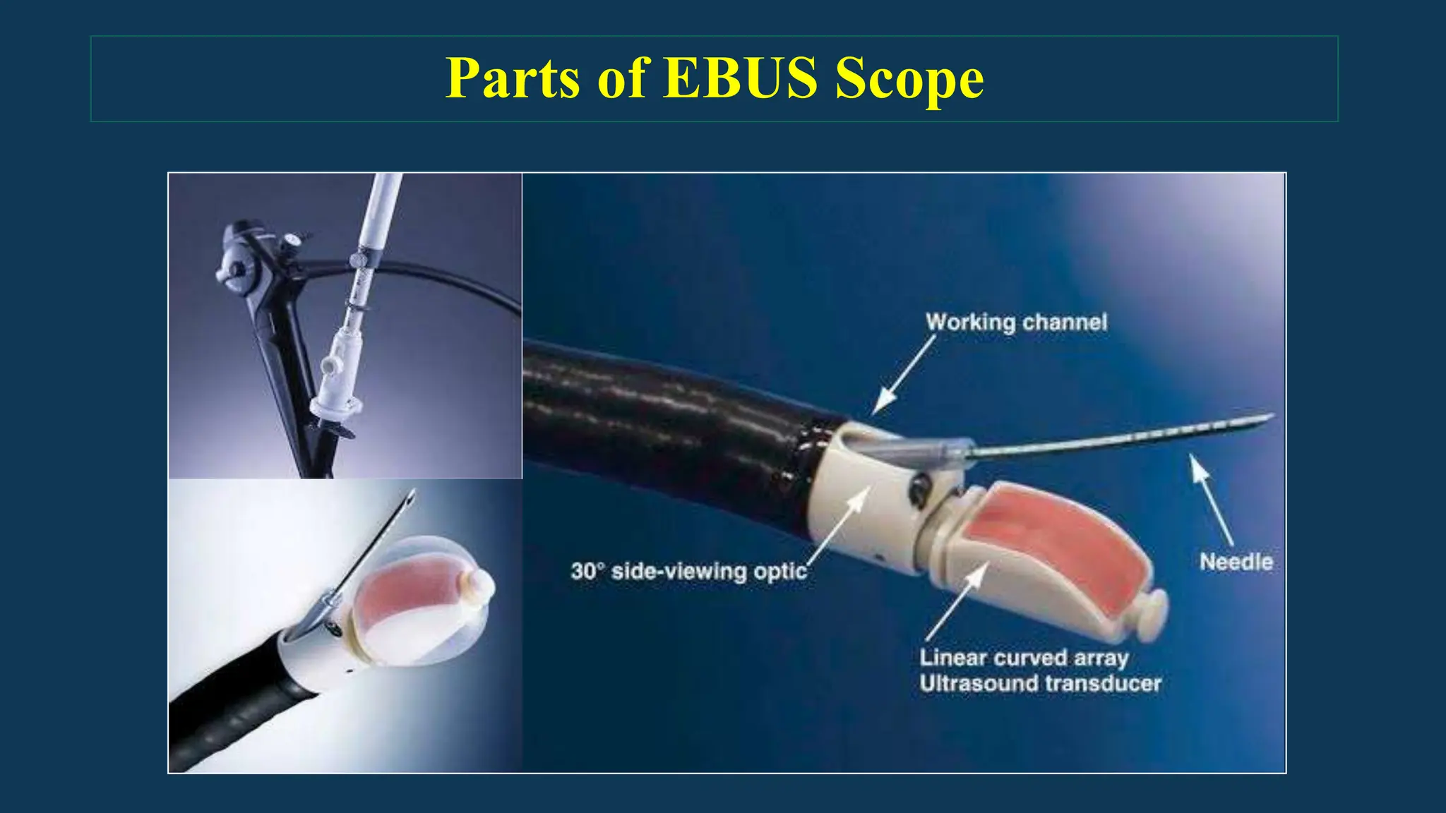 ENDO BRONCHEAL ULTRASONOGRAPHY (EBUS)_Chandan.pdf