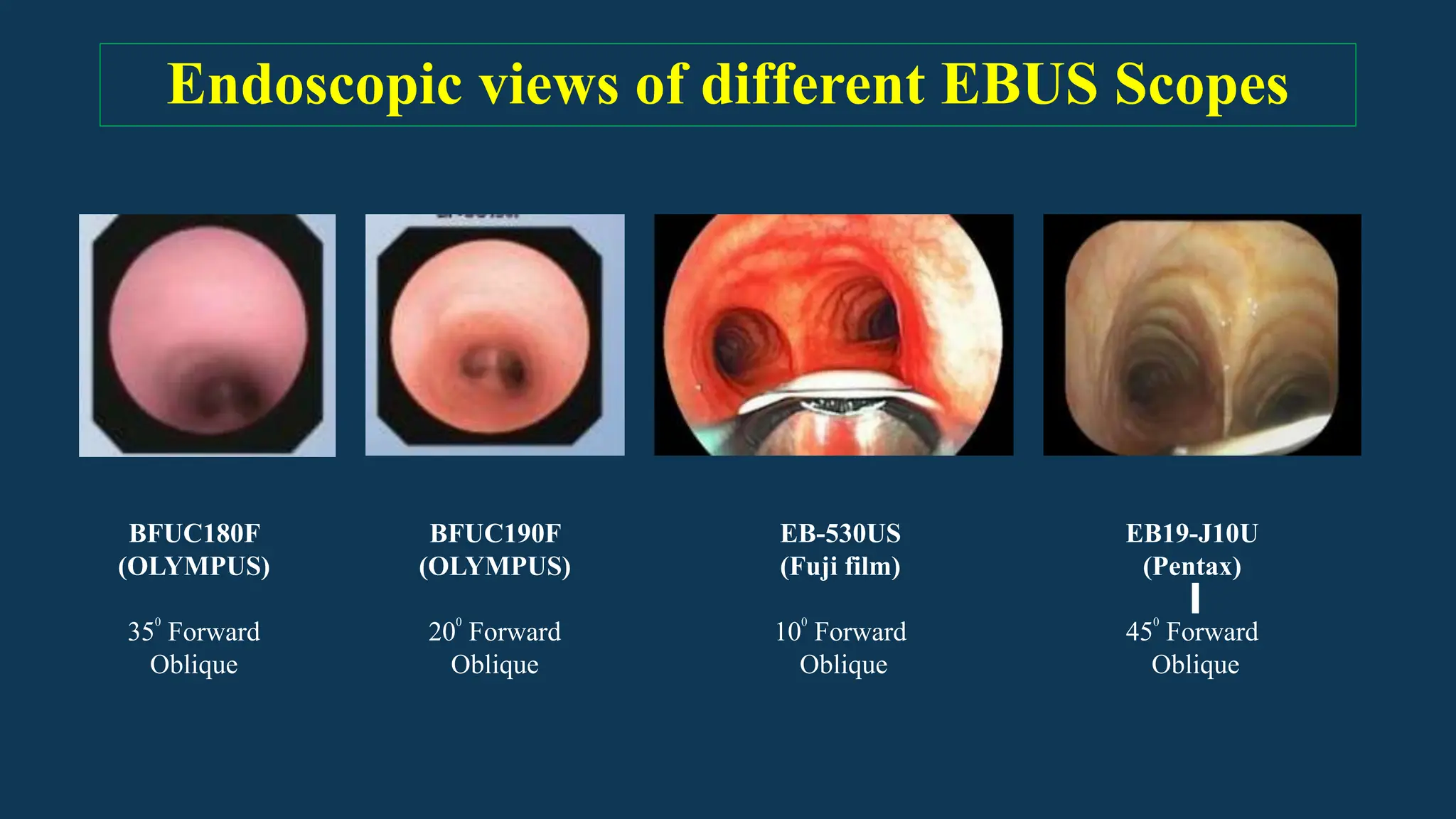 ENDO BRONCHEAL ULTRASONOGRAPHY (EBUS)_Chandan.pdf