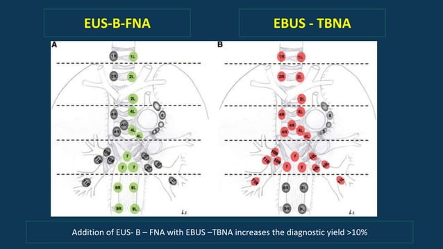 ENDO BRONCHEAL ULTRASONOGRAPHY (EBUS)_Chandan.pdf | Lung and ...