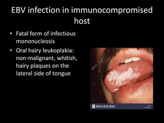 Epstein-Barr Virus (EBV) and Cytomegalovirus (CMV) by Dr. Himanshu ...