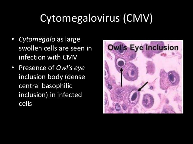 Epstein-Barr Virus (EBV) and Cytomegalovirus (CMV) by Dr. Himanshu Kh…