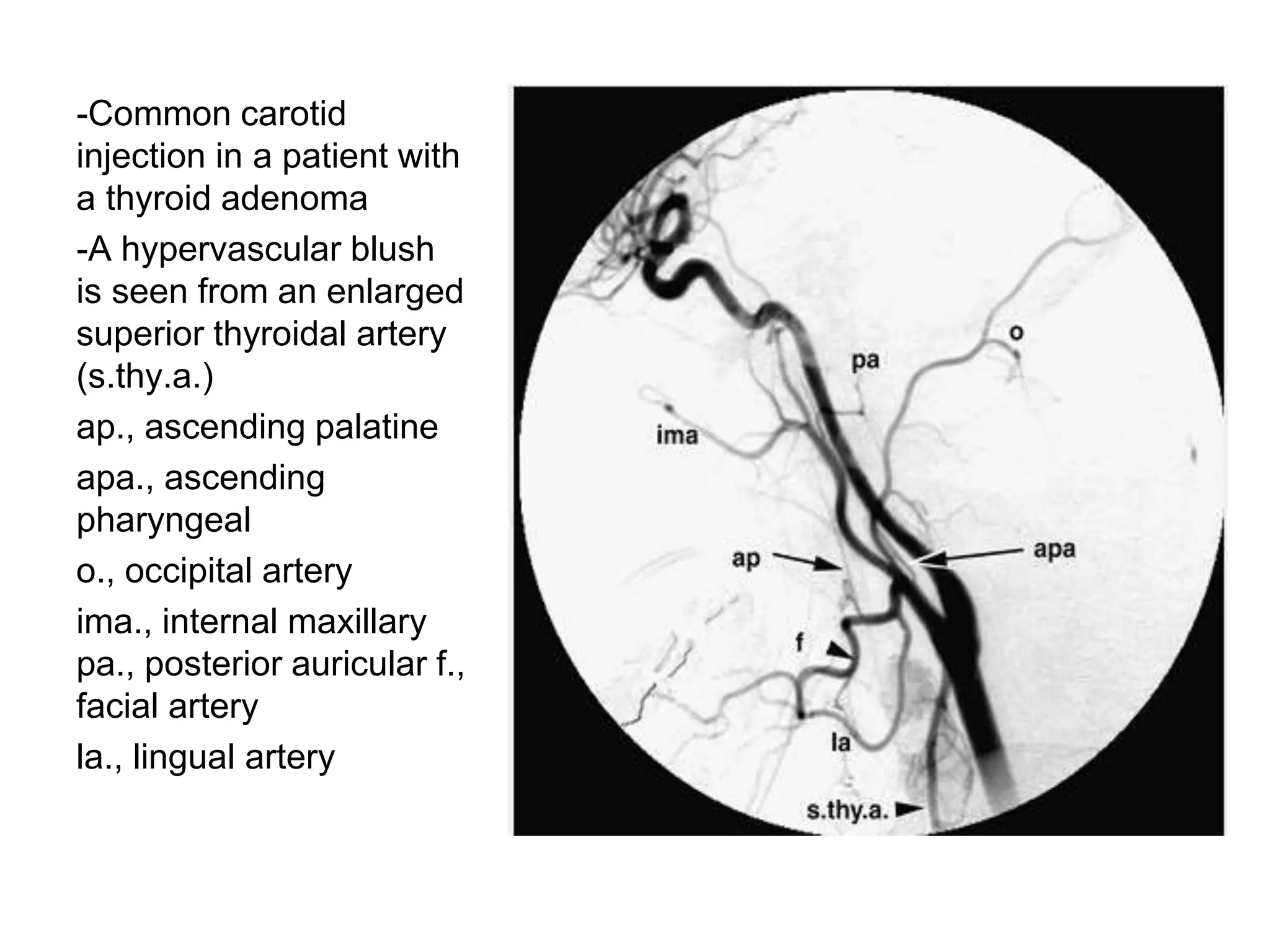 Anatomy of the external carotid artery (ECA) | PPT | Death, Injury, or Military Conflict ...