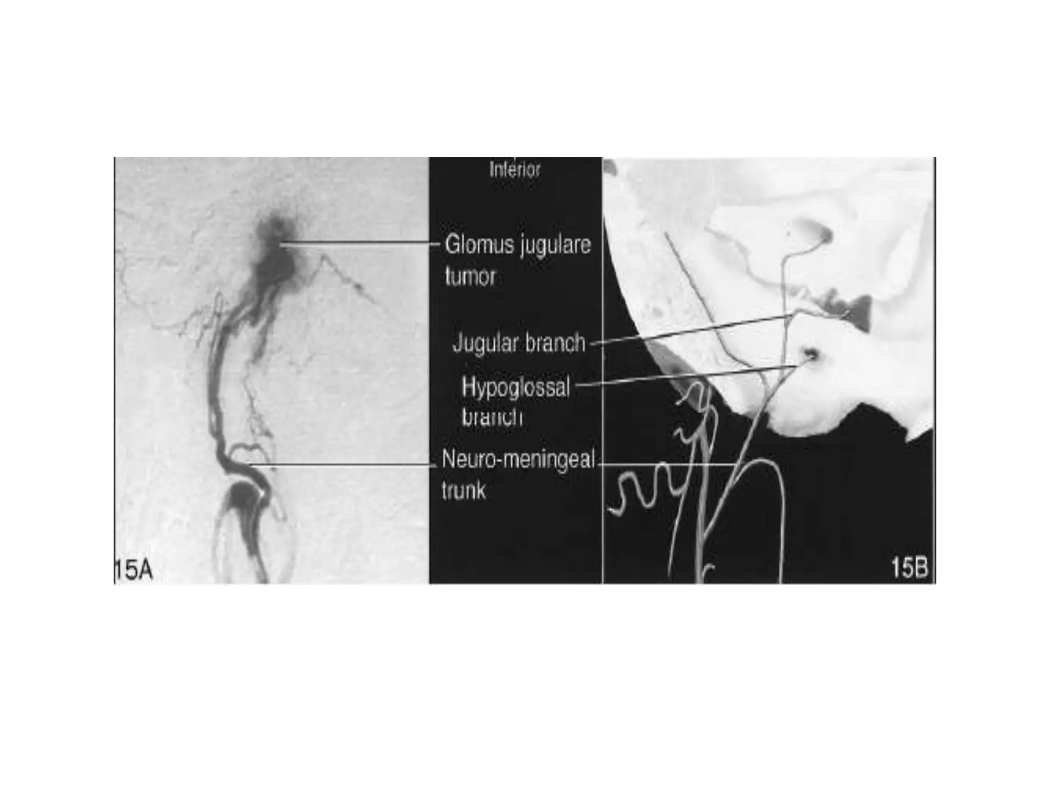 Anatomy of the external carotid artery (ECA) | PPT