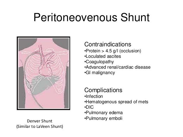 Denver Shunt Vs Tips | Overview of transjugular intrahepatic ...