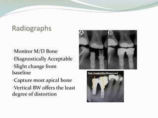 Implant Maintenance and Disease Prevention | PPTX | Dental Health ...