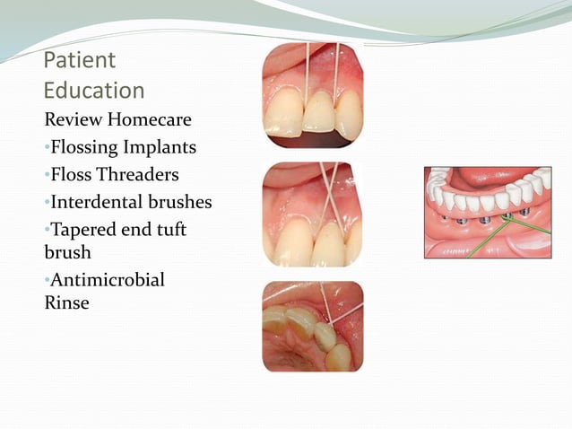 Implant Maintenance and Disease Prevention | PPTX | Dental Health ...