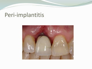 Implant Maintenance and Disease Prevention | PPTX | Dental Health ...