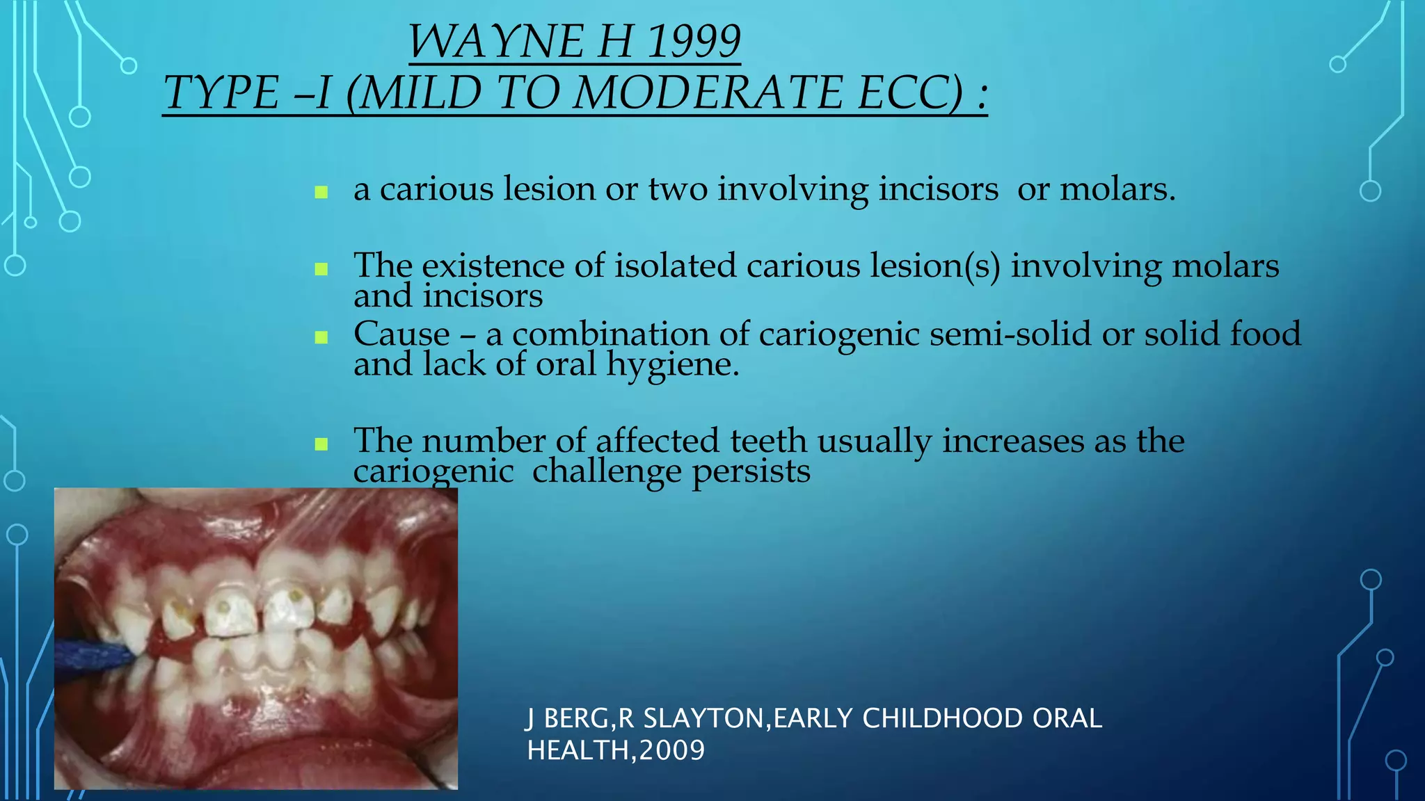 EARLY CHILDHOOD CARIES | PPTX