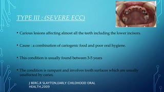 EARLY CHILDHOOD CARIES | PPTX