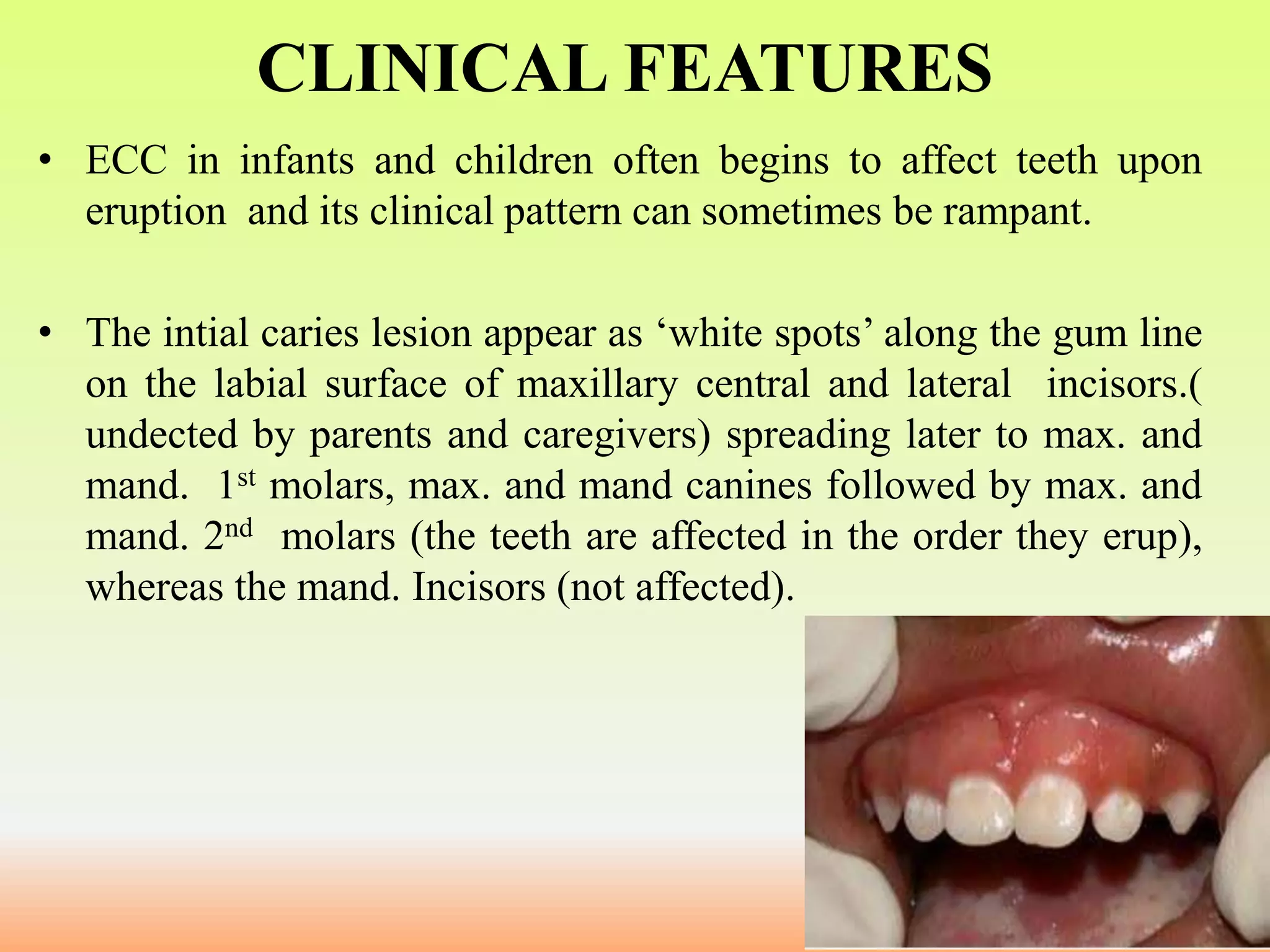 Early childhood caries | PPTX
