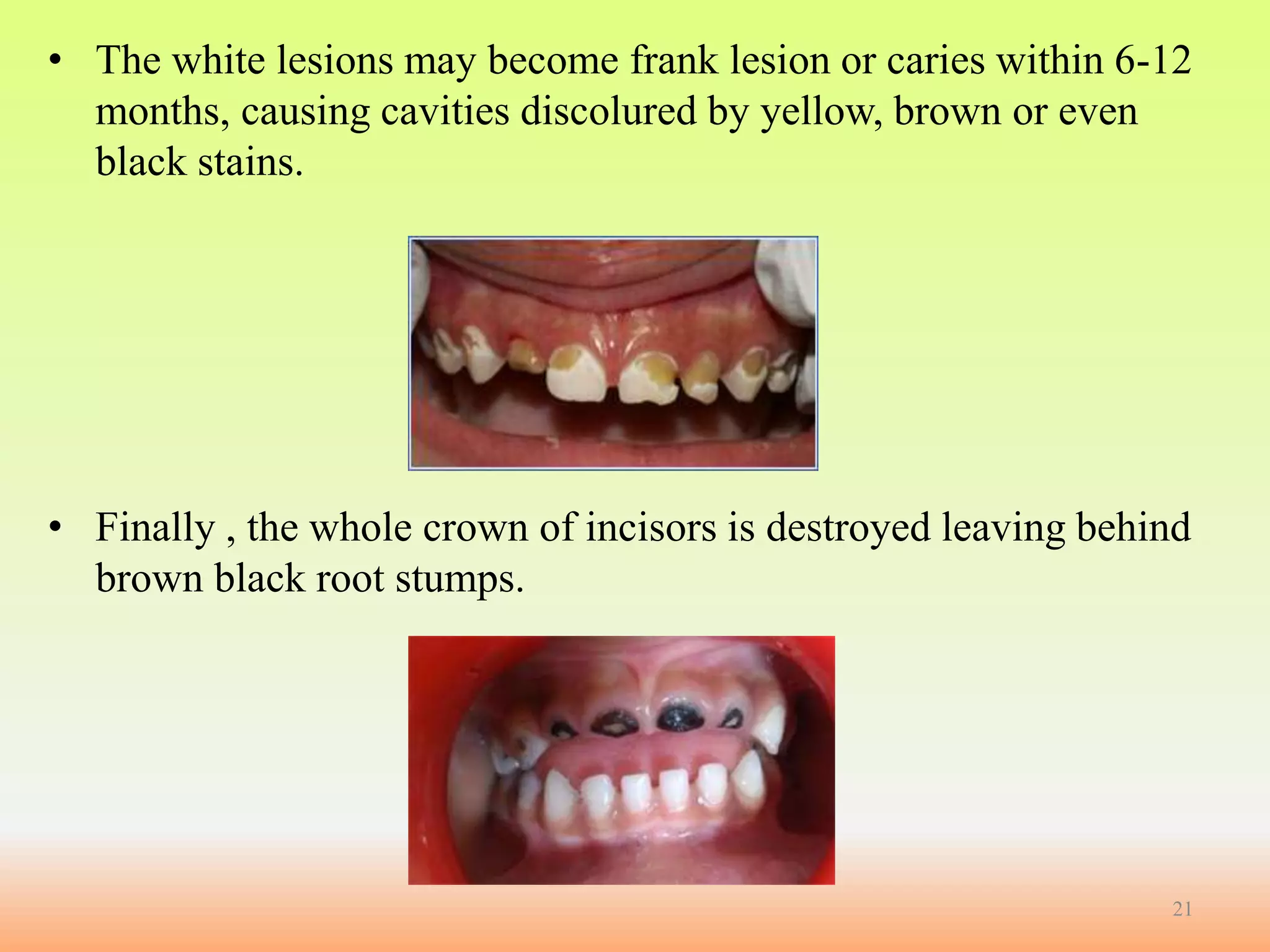 Early childhood caries | PPTX