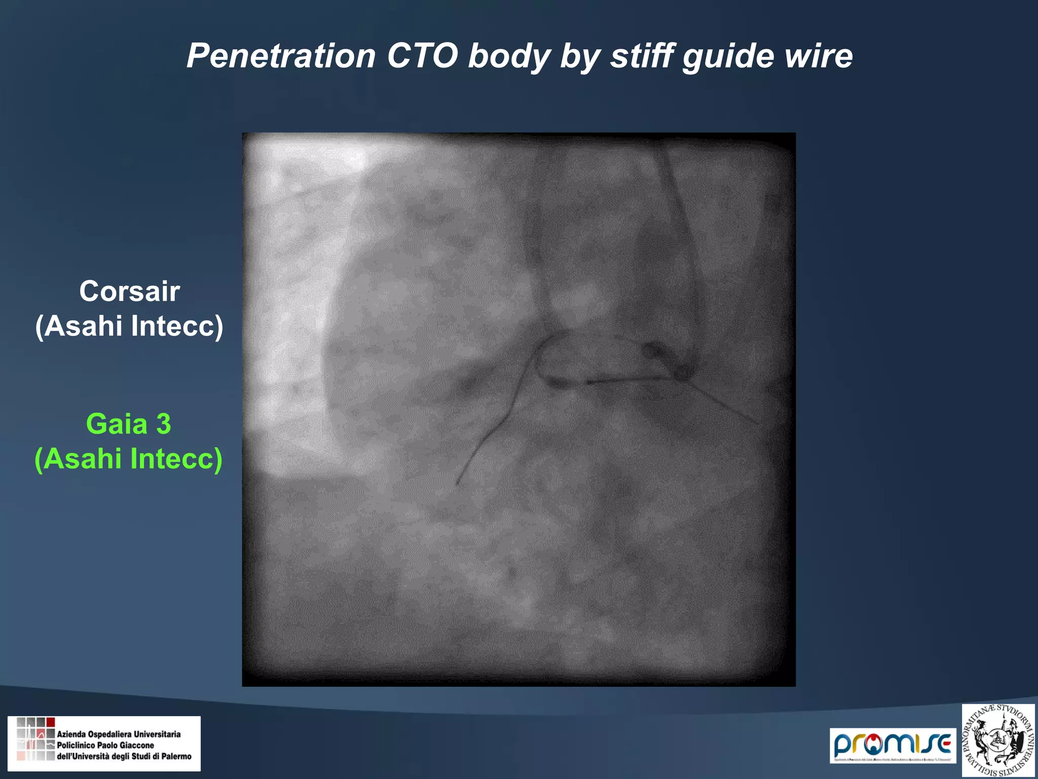 Novel antegrade wire dissection techniques | PPT