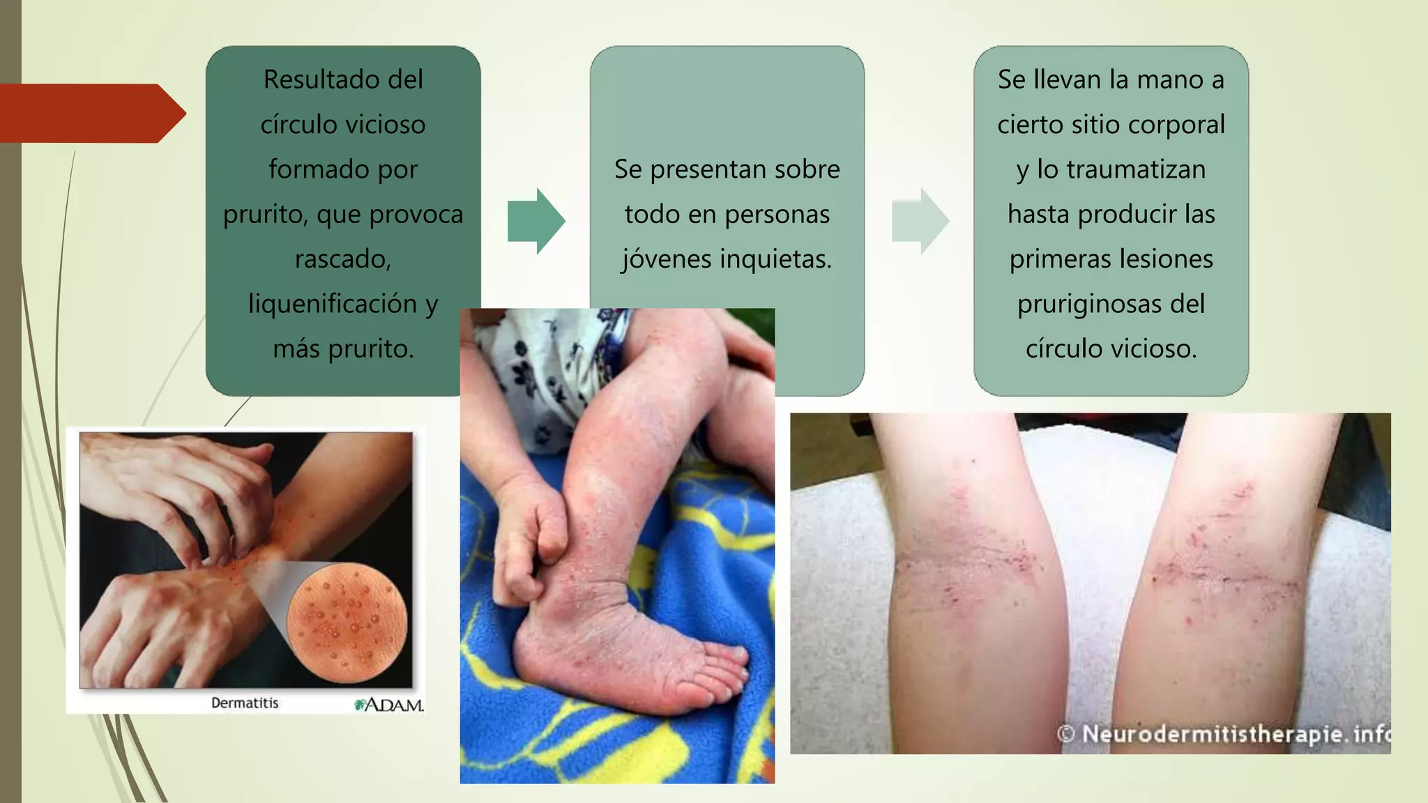 Eccema numular y Liquen Simple Crónico (Neurodermatitis circunscrita ...