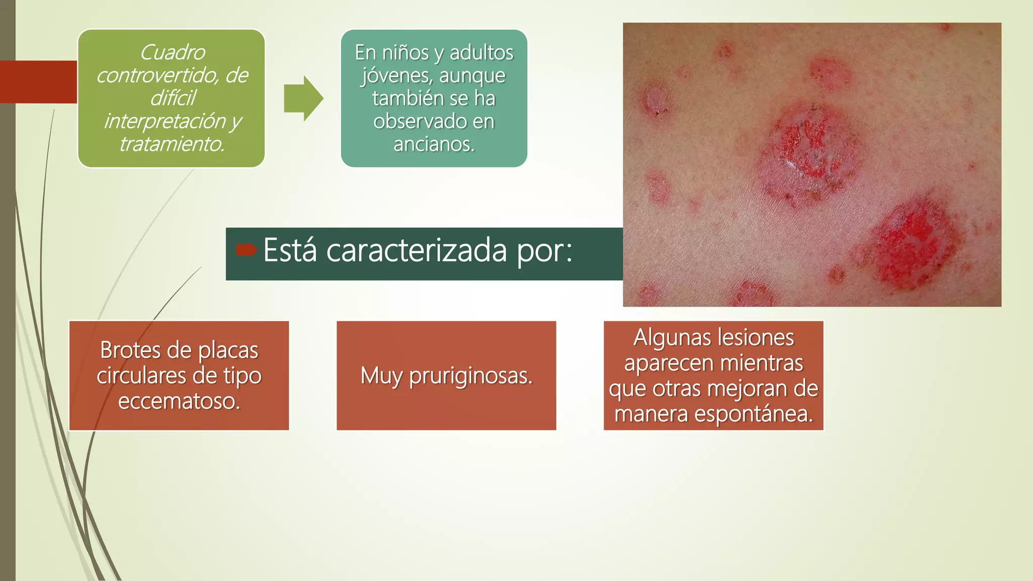Eccema numular y Liquen Simple Crónico (Neurodermatitis circunscrita ...