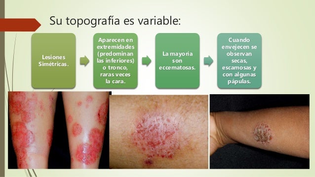 Eccema numular y Liquen Simple Crónico (Neurodermatitis circunscrita)