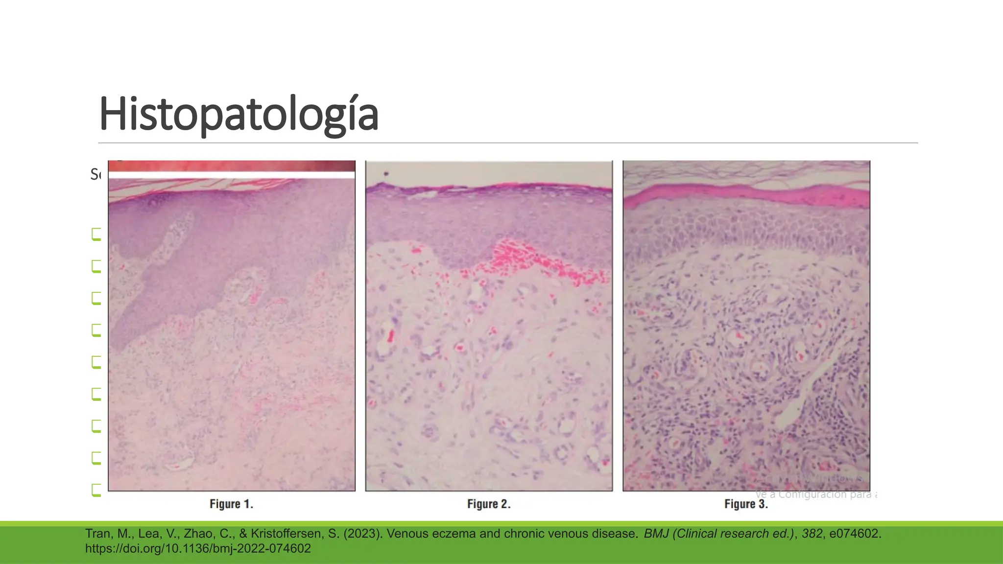 Eccema por estasis - Dermatitis atópica | PPTX