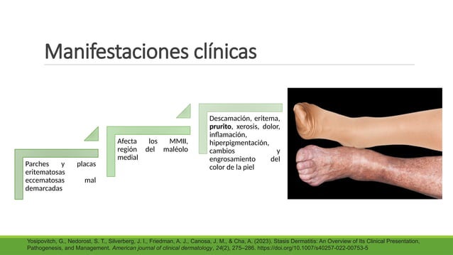 Eccema por estasis - Dermatitis atópica | PPTX