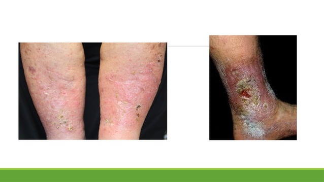 Eccema por estasis - Dermatitis atópica | PPTX