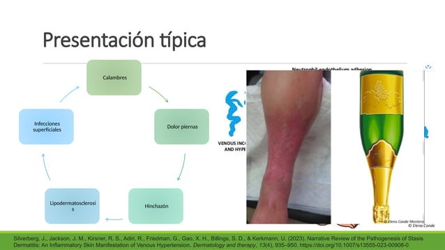 Eccema por estasis - Dermatitis atópica | PPTX