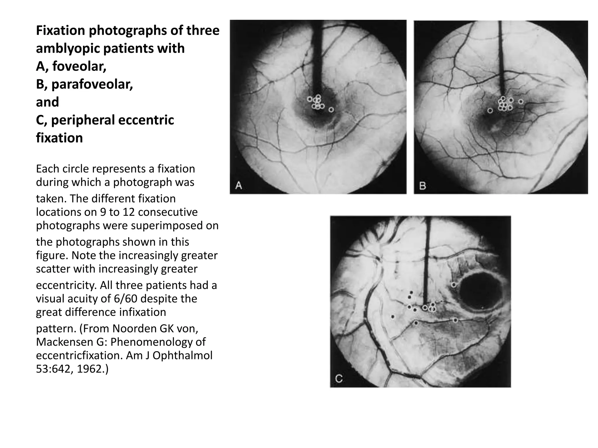 Eccentric fixation, investigation and management | PPTX