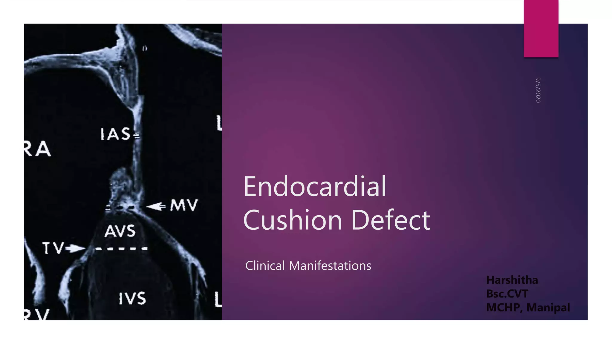 Endocardial Cushion Defect Avsd Ppt