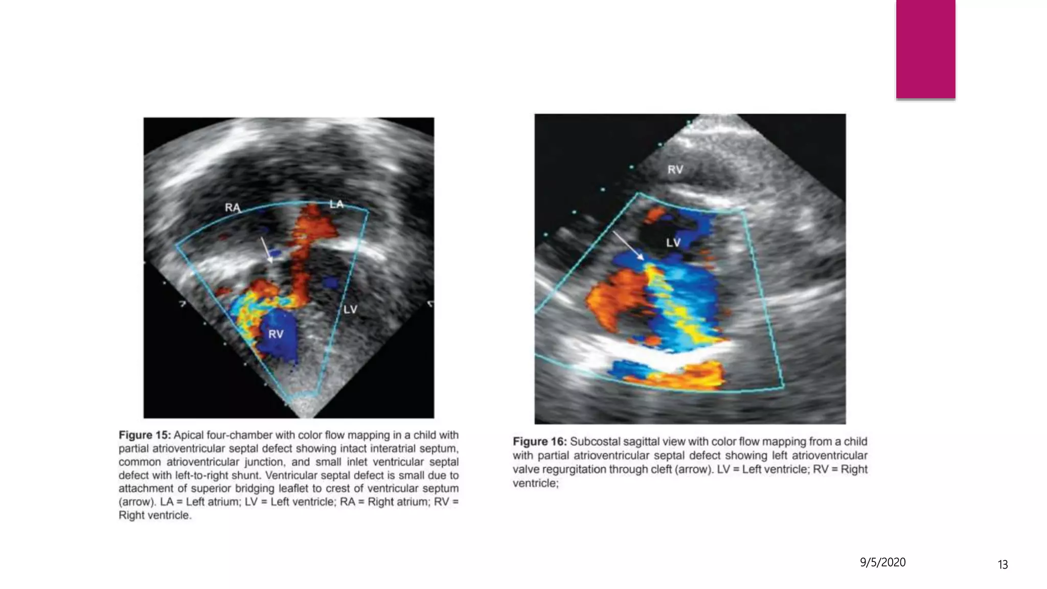 Endocardial Cushion Defect / AVSD | PPTX