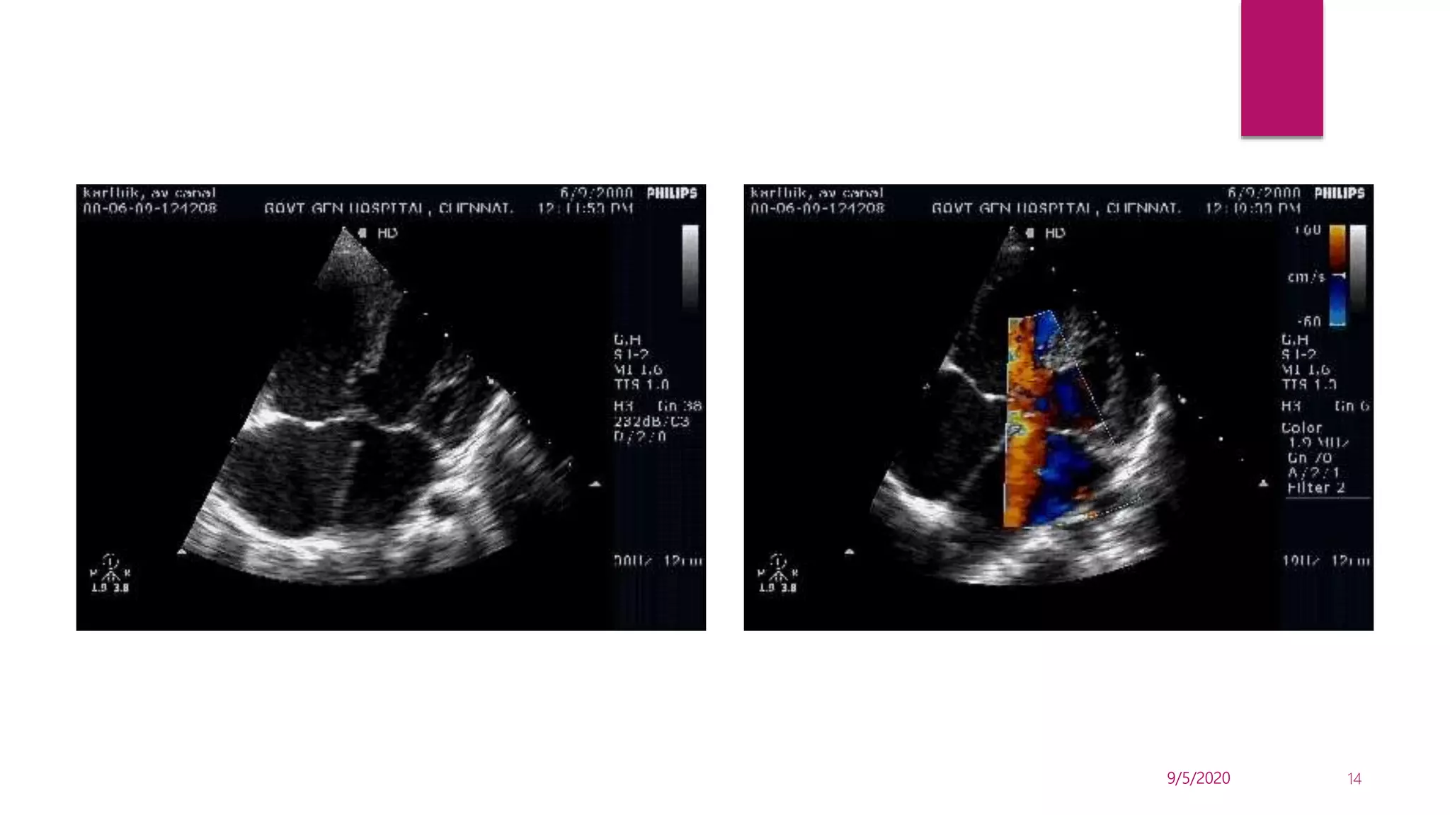 Endocardial Cushion Defect Avsd Ppt
