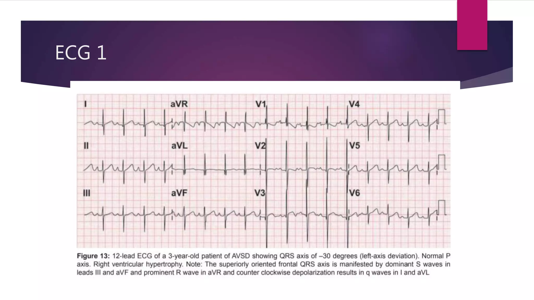 Endocardial Cushion Defect Avsd Ppt