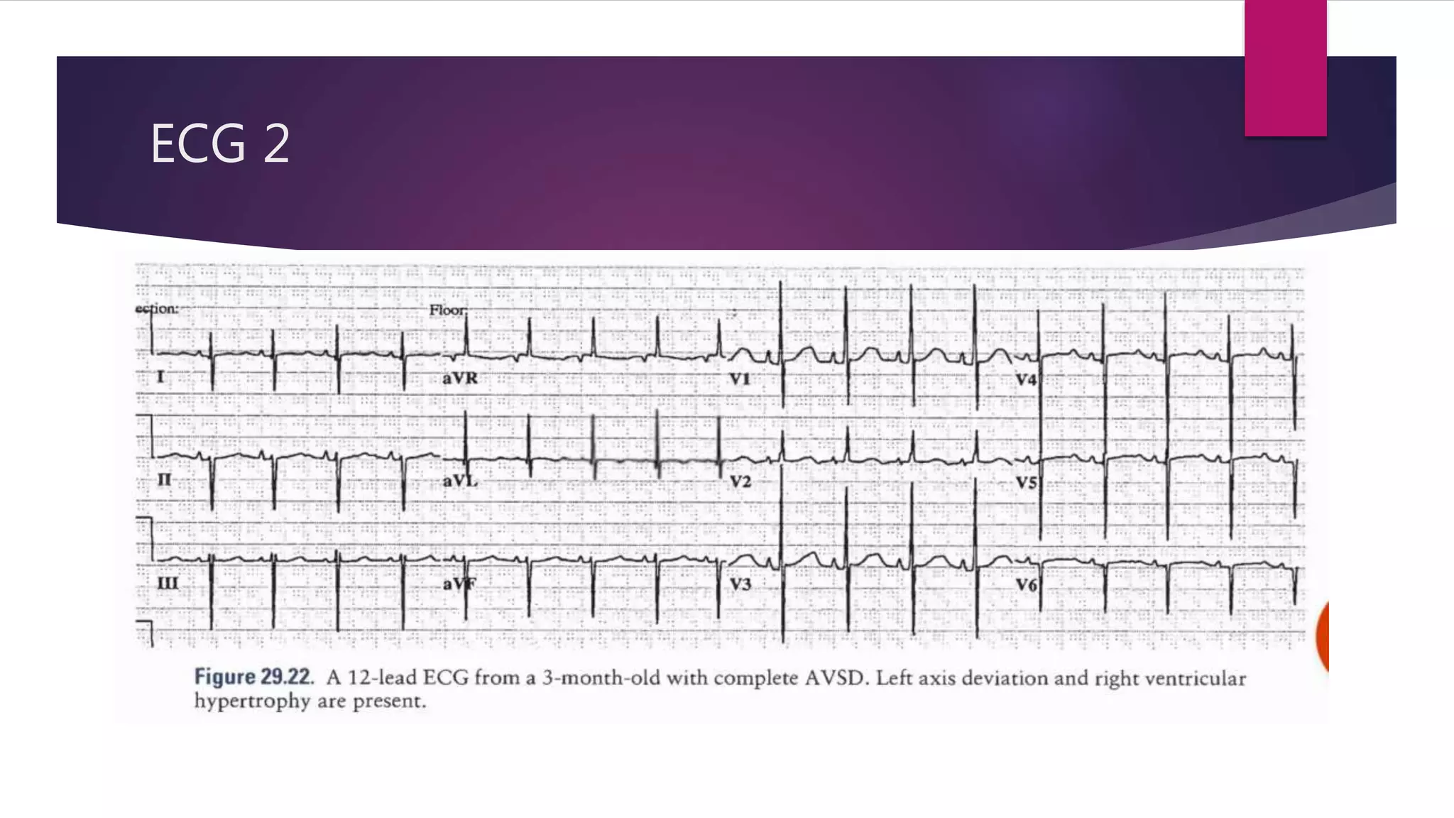 Endocardial Cushion Defect / AVSD | PPTX